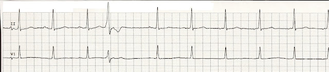 EKG Rhythm Strips 52