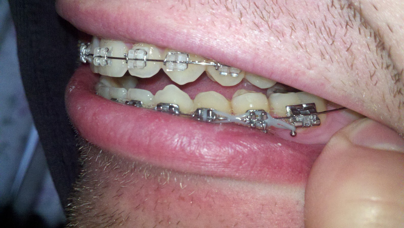 Braces/Open Bite Surgery: First Ortho Meeting Since Having Braces On