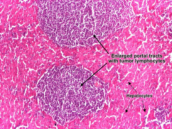 موقع الدكتور أحمد كلحى: باثولوجى Pathology Slides : Hematopathology