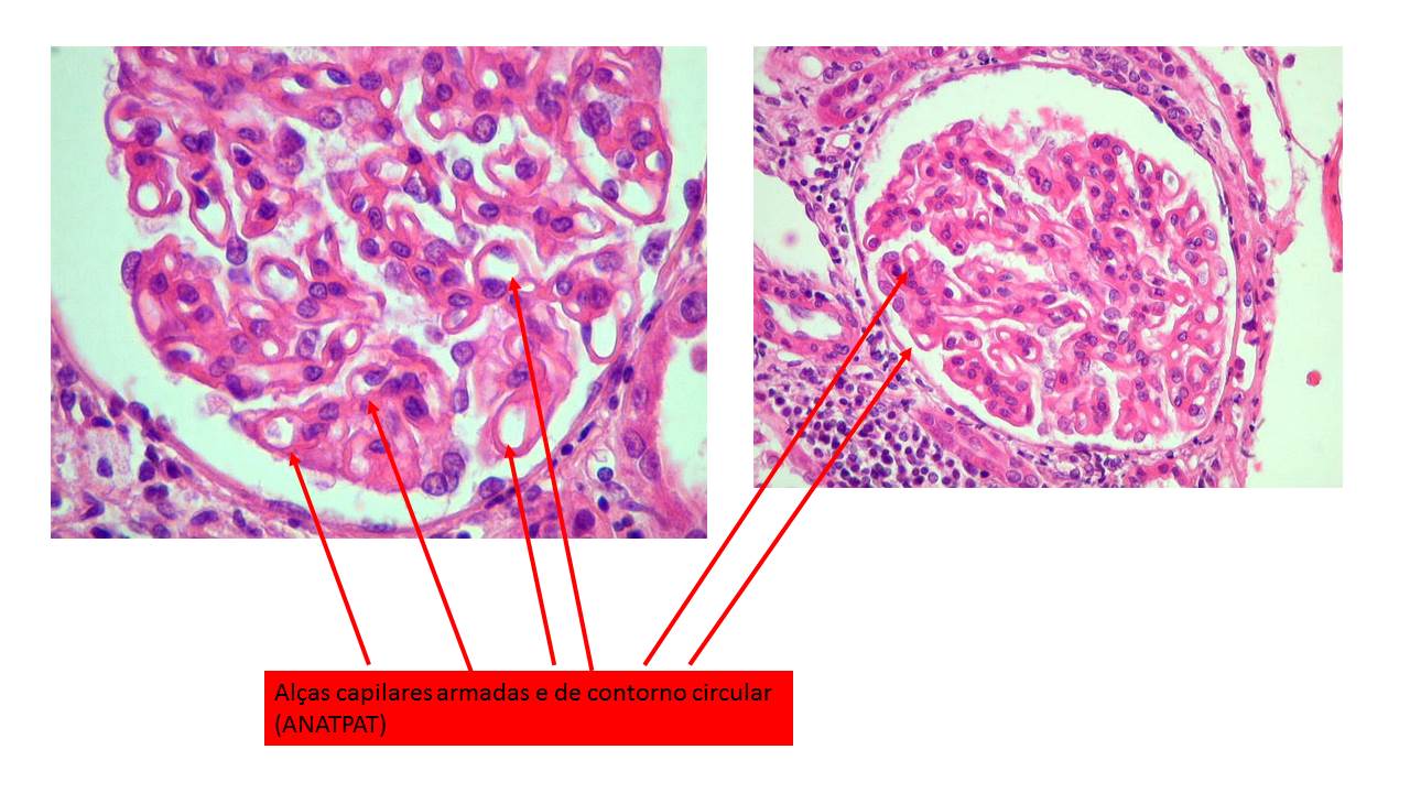 HISTOLOGIA90: RIM NORMAL E GLOMERULONEFRITES