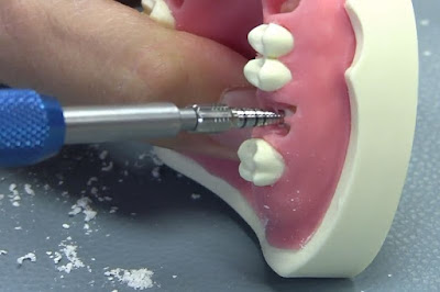 IMPLANTOLOGY: Immediate placement in molar site utilizing bone ...