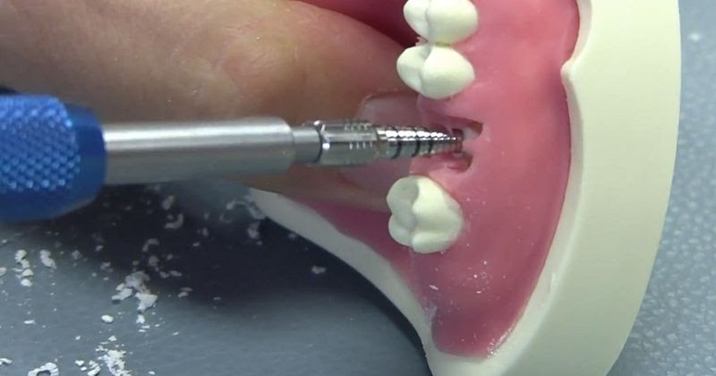 IMPLANTOLOGY: Immediate placement in molar site utilizing bone ...