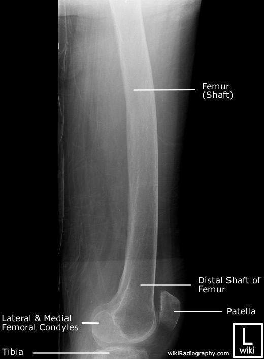 ANATOMI RADIOGRAFI FEMUR - Radiografer