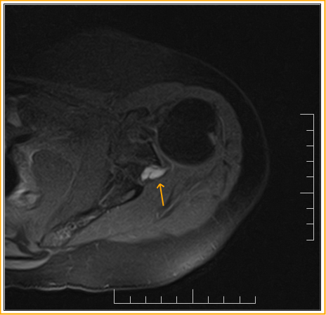 Paralabral Cyst: MRI - Sumer's Radiology Blog