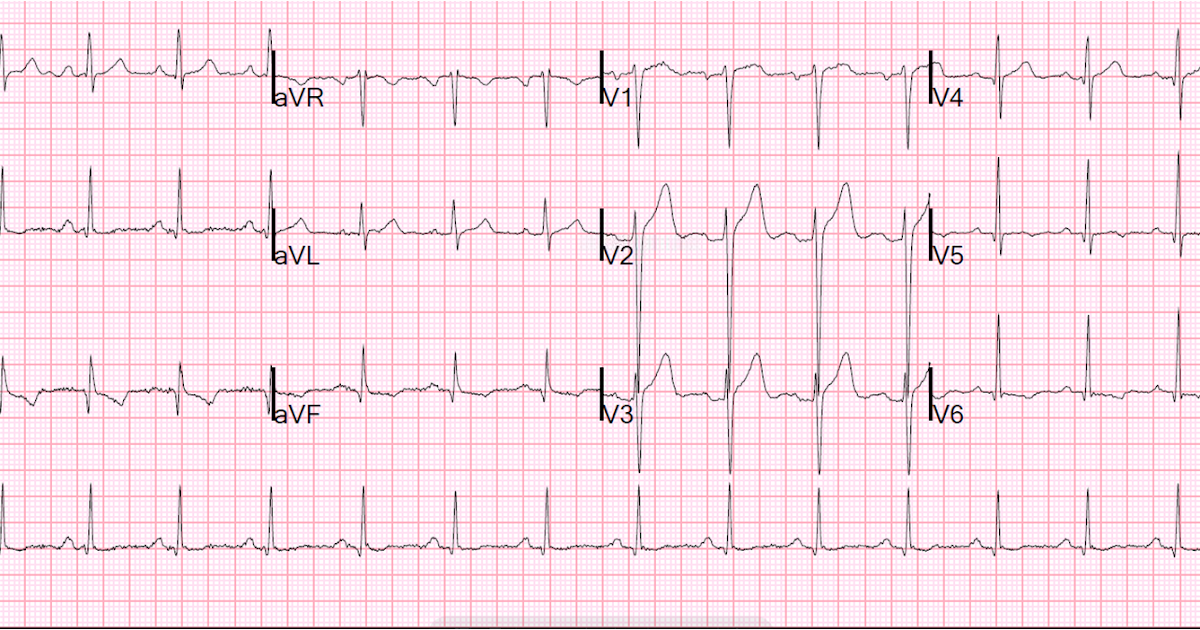 Dr. Smith's ECG Blog: Anterior ST elevation: Anterior STEMI? A ...