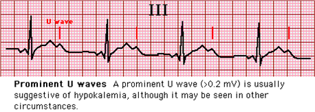 IPHREHAB: IPHREHAB : HOW TO READ ECG