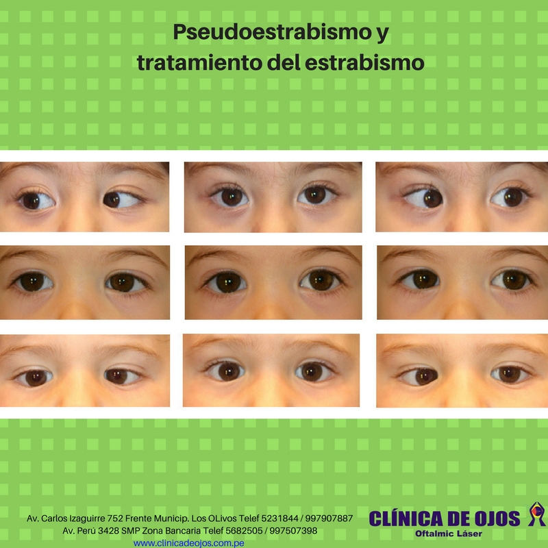 Clínica de Ojos Oftalmic Láser: Pseudoestrabismo y tratamiento del estrabismo