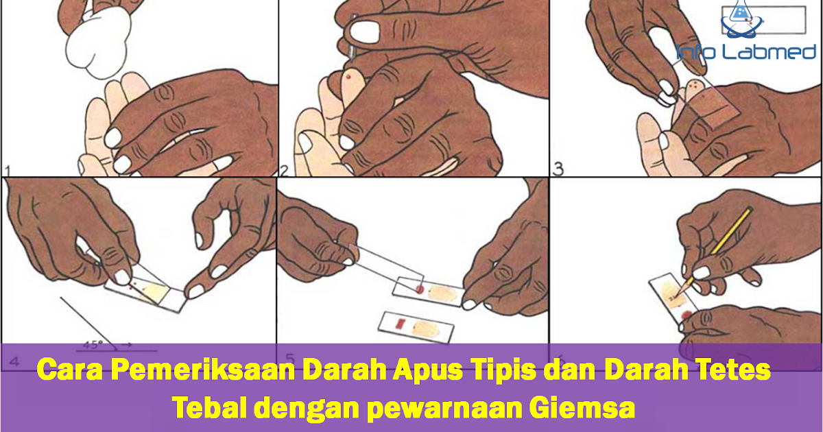Cara Pemeriksaan Darah Apus Tipis dan Darah Tetes Tebal dengan ...