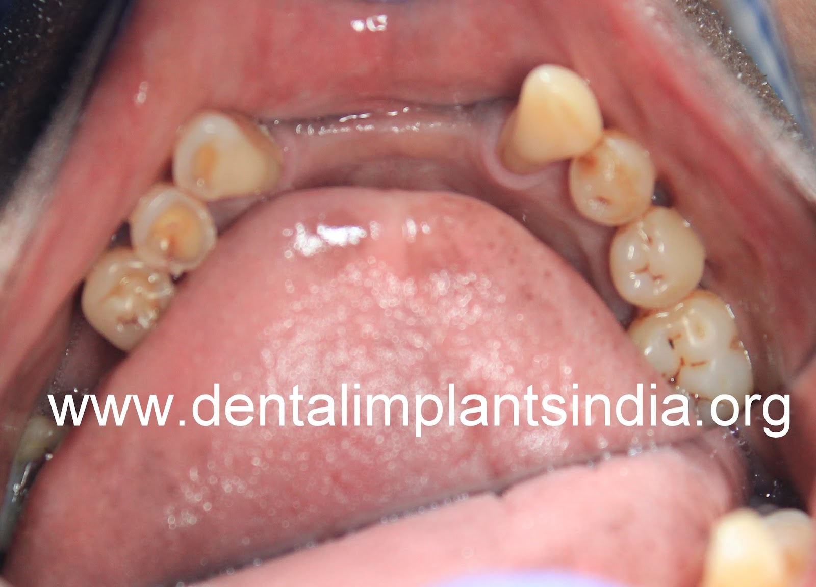 Chinthamani Laser Dental Clinic: REPLACEMENT OF MISSING LOWER FRONT ...