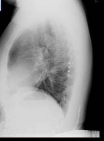 Another Implant for the Radiologists-Spinal Cord Stimulator - Sumer's ...