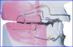 APARATOLOGIA ORTOPEDICA: OTROS TIPOS DE FRANKEL