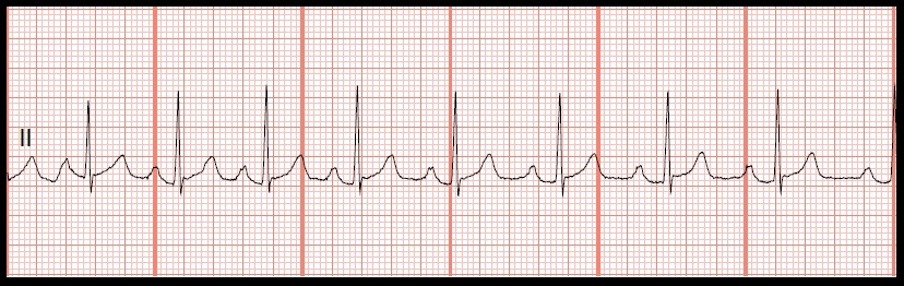 Practice EKG Rhythm Strips 124
