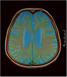 Nevit's blog: False-color Brain MRI (Motion artifacts)
