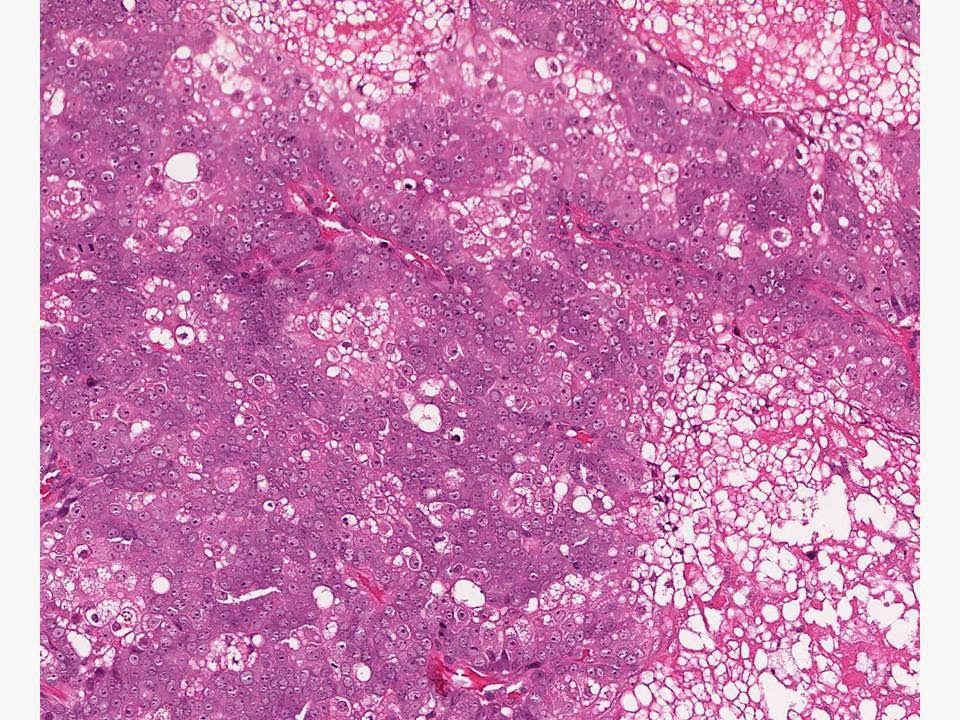 Dermpath Made Simple - Neoplastic: Sebaceous Tumours