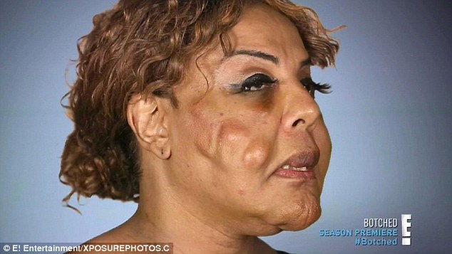 Transgender Rajee Narinesingh Has Cement In Face Finally Removed