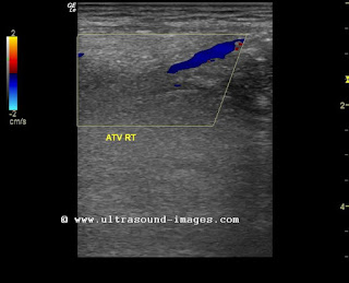 Ultrasound imaging: Deep-vein thrombosis- before and after treatment: