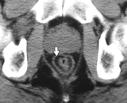 Ultimate Radiology : Causes of CT Bowel Fat Halo Sign