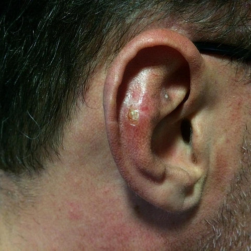 Cancer Of The External Ear Types Symptoms Staging And Treatment cancer-of-the-external-ear-types-symptoms-staging-and-treatment