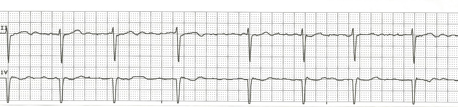 EKG Rhythm Strips 83