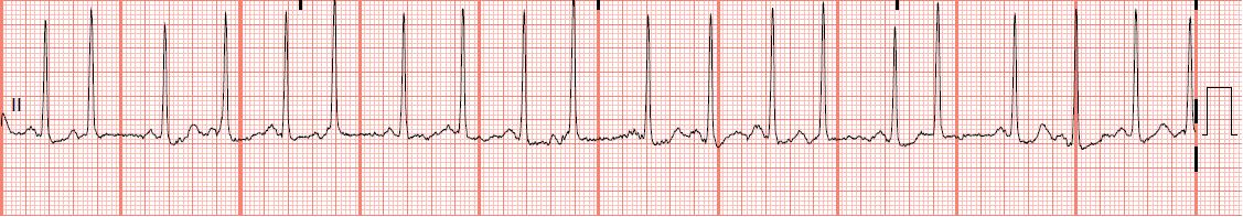 EKG Rhythm Strip Quiz 53: Atrial Rhythms