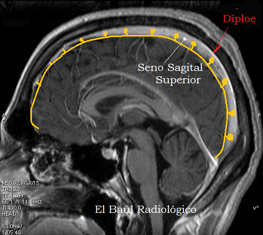 El Baúl Radiológico: 1) GRANULACIONES ARACNOIDEAS. GRANULACIONES DE ...
