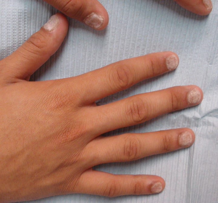 VIRTUAL GRAND ROUNDS IN DERMATOLOGY 2.0: Alopecia Areata and Twenty ...