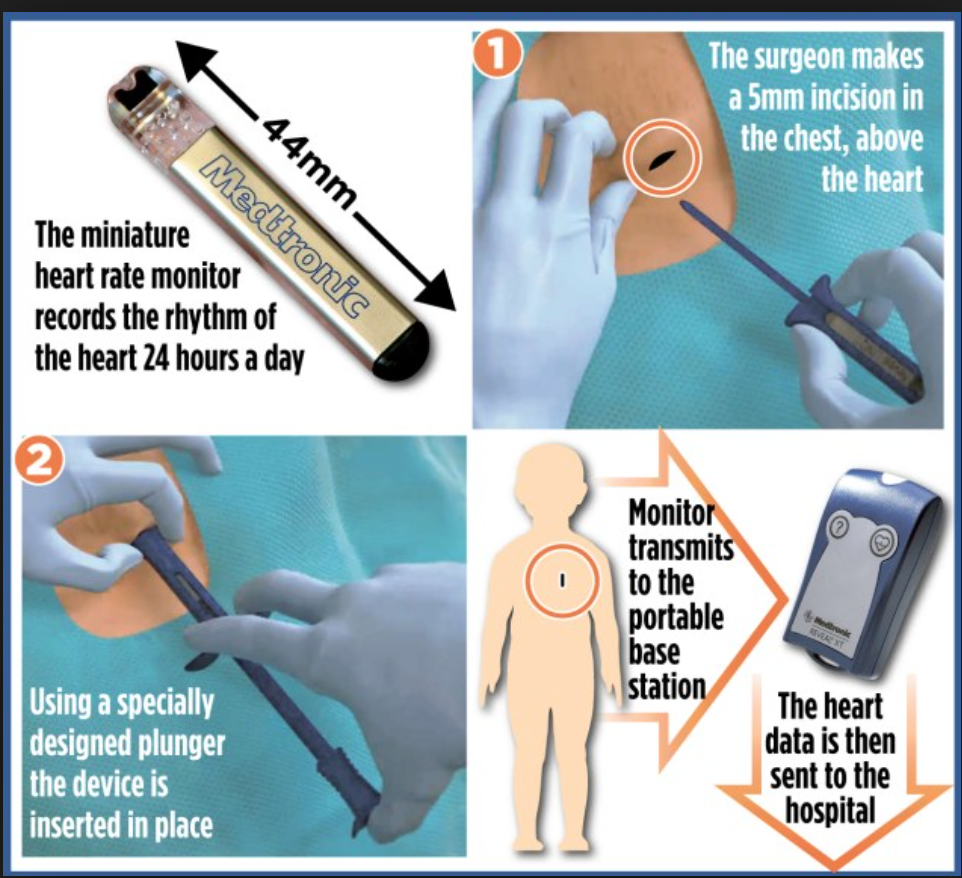 Kiwi Adventure: "Up Skill" To Insert Reveal LINQ Cardiac Moniter