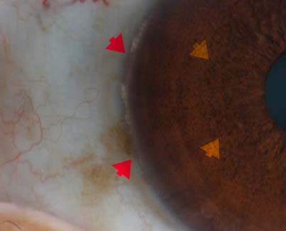 Modern & Multidimensional Iridology: Ferrum Chromatosis, Mammilations ...