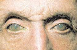 Photos for Argyrosis ~ YOUNG DOCTORS' RESEARCH FORUM