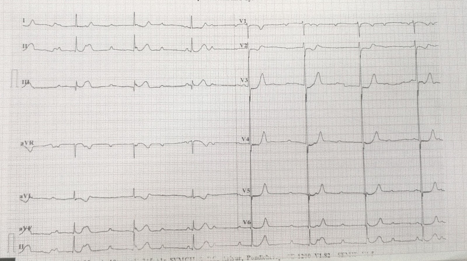 Cardiology window: Inferior wall myocardial infarction presenting as ...
