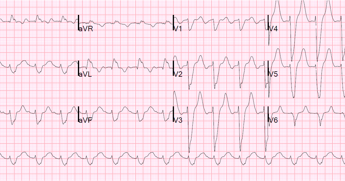 Dr. Smith's ECG Blog: Hyperkalemia in the setting of Left Bundle Branch ...