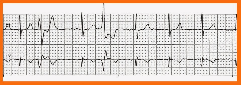 Various Rhythms with Multifocal PVCs
