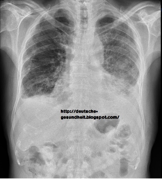 Medizin - Gesundheit: Rö Thorax mit Pleuraerguss Partielle Atelektase