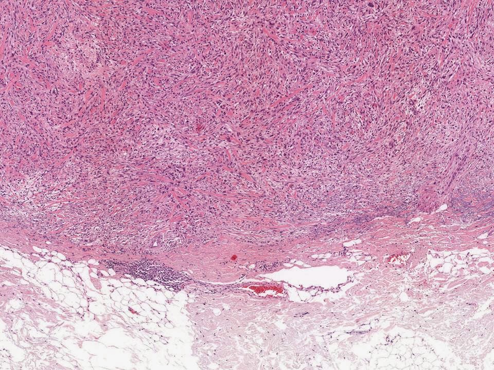 Dermpath Made Simple - Neoplastic: Atypical Fibroxanthoma