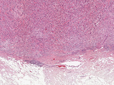 Dermpath Made Simple - Neoplastic: Atypical Fibroxanthoma