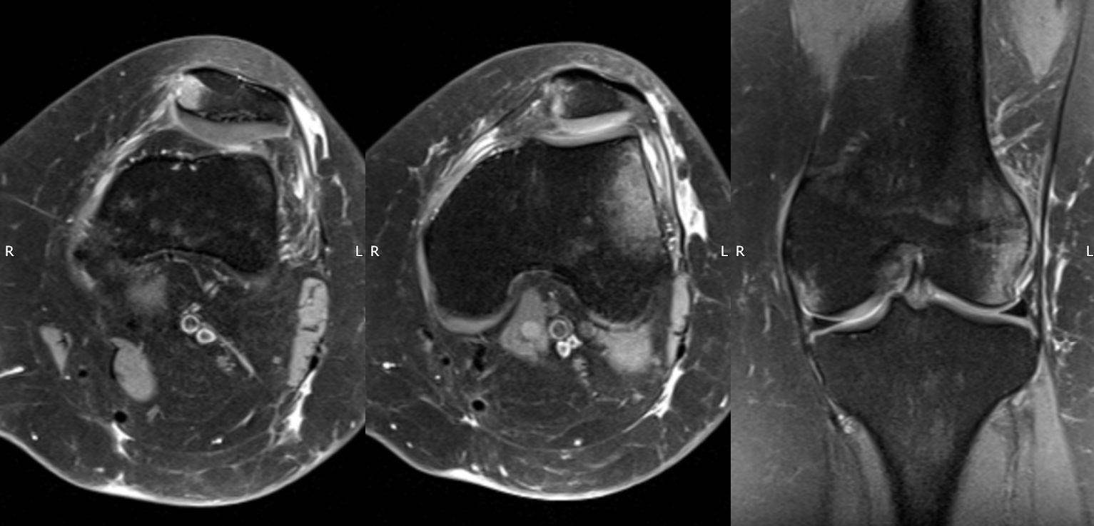 Transient patellar dislocation