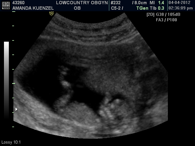 Amy's World: 12 Weeks NT Scan