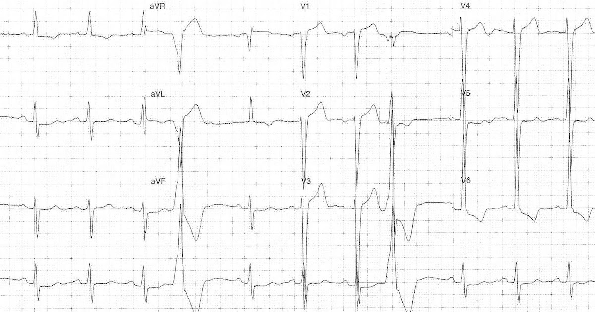 ECG of the Week: ECG of the Week - 5th November 2018 - Interpretation