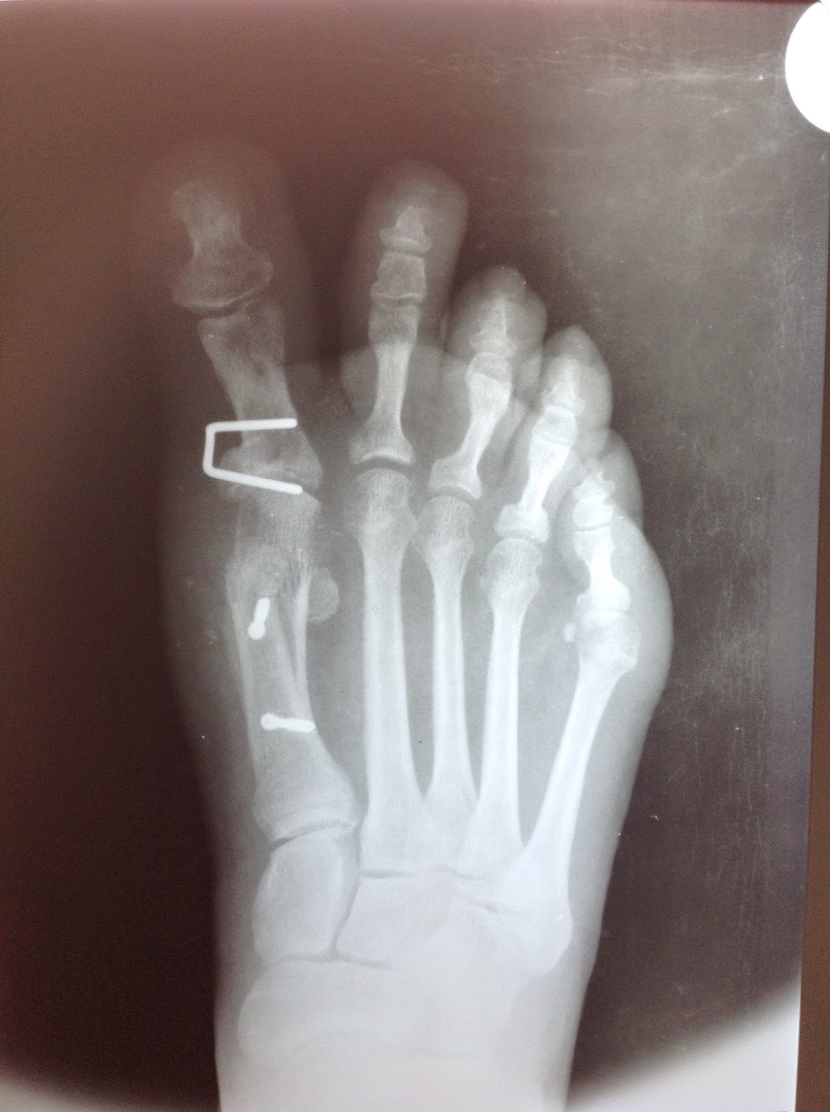 Blog del Dr. Joaquín Oscar Izquierdo: Iatrogenia primer dedo pie ...