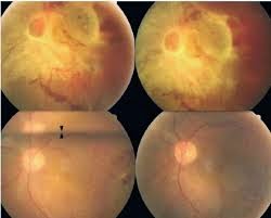 Medical Treatment Pictures-for Better Understanding: Vitrectomy Surgery ...
