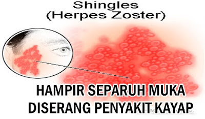 HAMPIR SEPARUH MUKA MELEPUH DISERANG PENYAKIT KAYAP