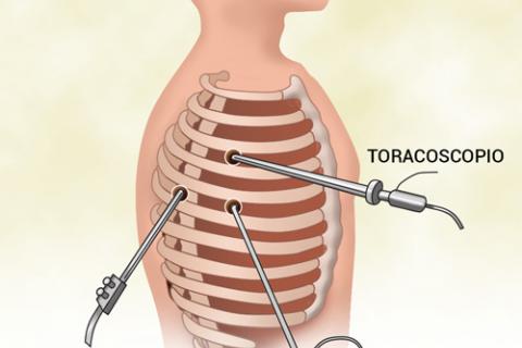Pruebas Dx: ¿Qué es una toracoscopia?