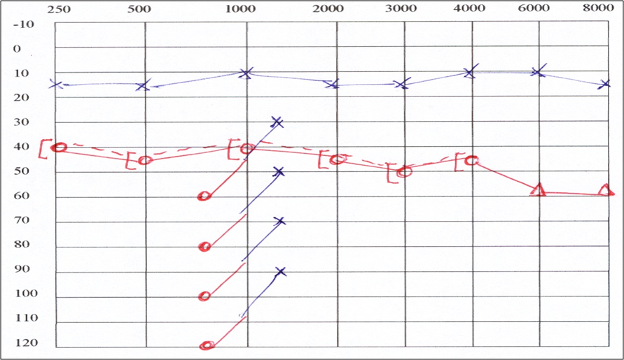 Pruebas Especiales Supraliminares para la Detección de Reclutamiento ...