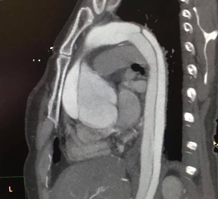 Aortic Dissection: Teaching Points - Sumer's Radiology Blog