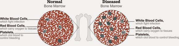 Medical Treatment Pictures-for Better Understanding: Leukemia – Chronic ...