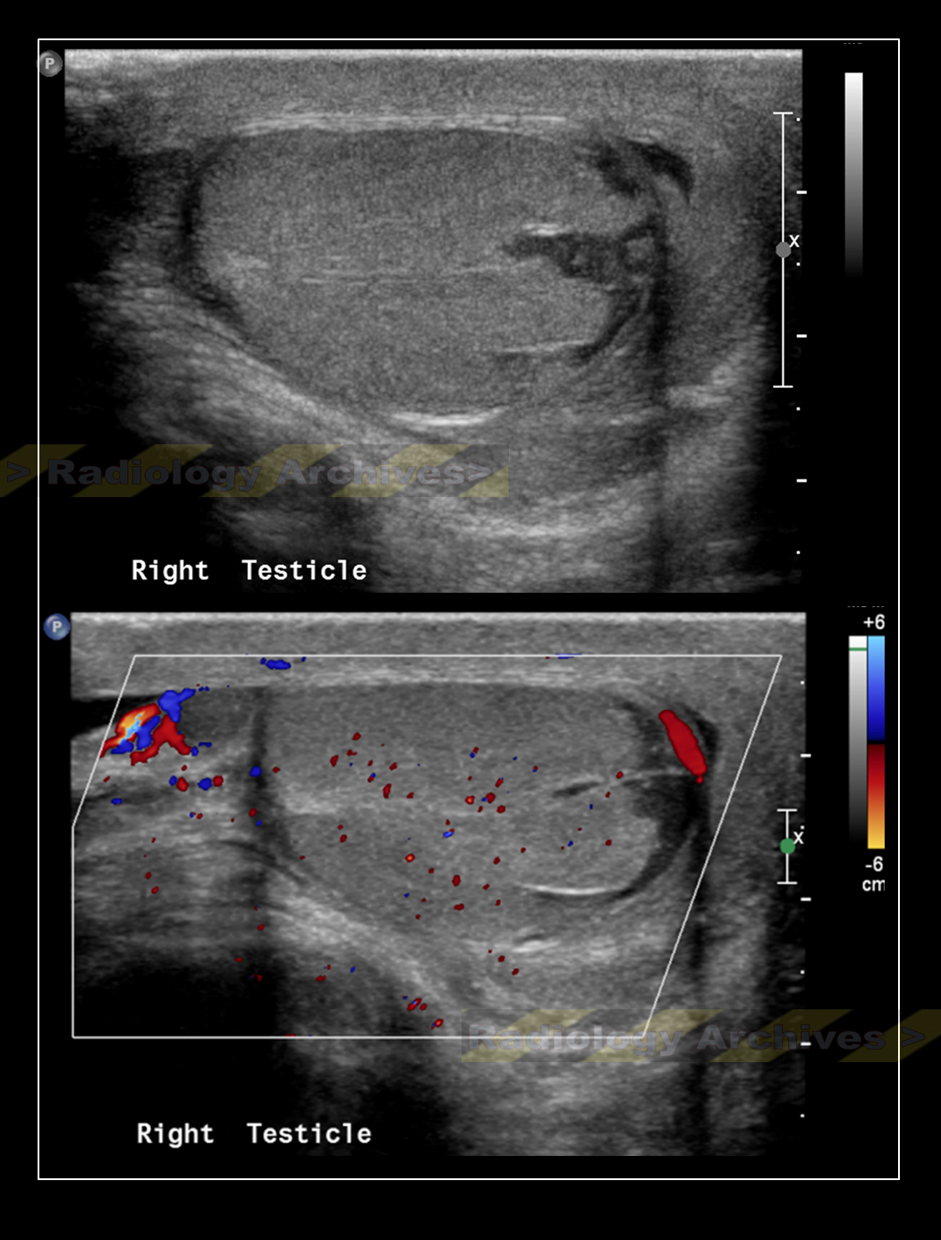 Radiology Archives: Ρήξη Όρχεως