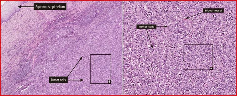 Histology: Cervical Cancer: Histological Findings