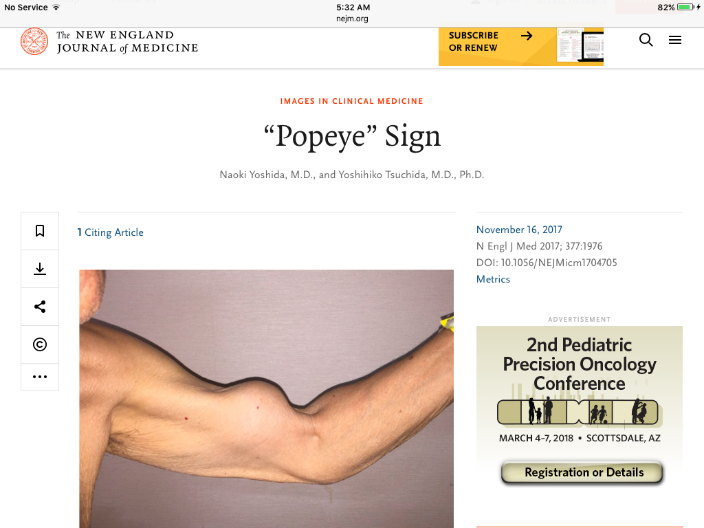 VIETNAMESE MEDIC ULTRASOUND: CASE 478: POPEYE’ SIGN of BICEPS MUSCLE ...