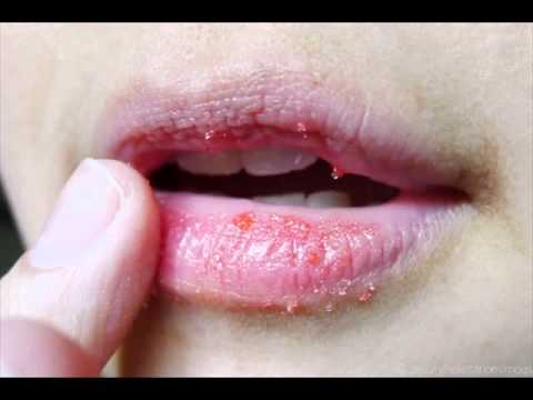 Natural Remedies For Cracked Mouth Corners