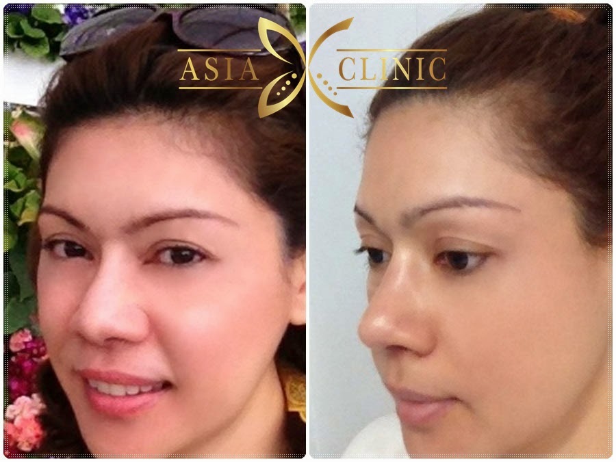 Revision Rhinoplasty - BEFORE AND AFTER PHOTOS ~ Asia Plastic Hospital